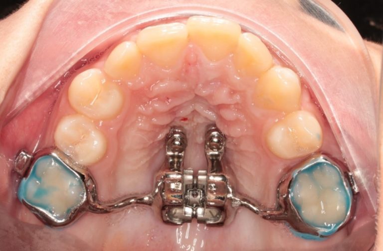 Аппарат MARPE в ортодонтии - ВилмаДент